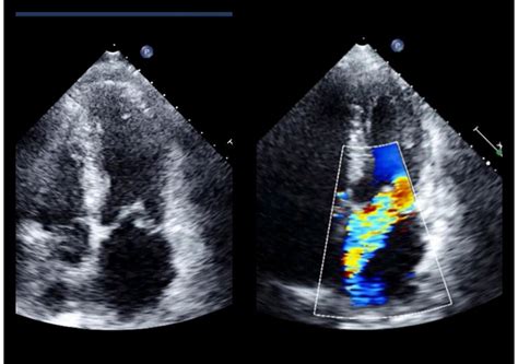 Echocardiographic Management Of Papillary Muscle Rupture During Acute