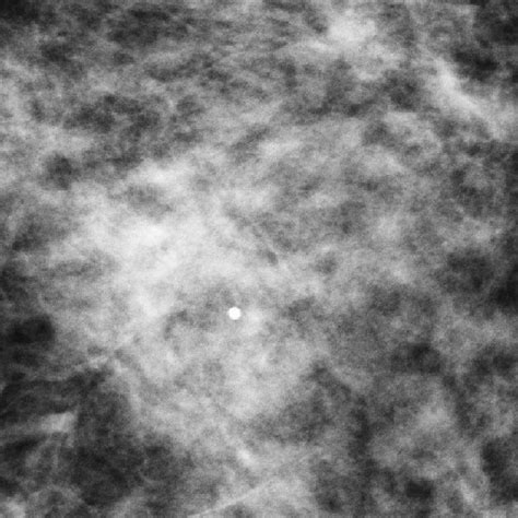 Patient 2 Pleomorphic Calcifications Well Circumscribed Calcification