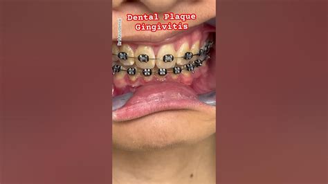 Gingivitis And Braces Orthodontics Treatments And Oral Hygiene Youtube