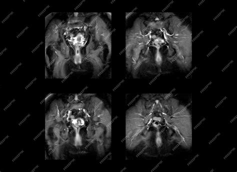 Pelvic Mri Procedure