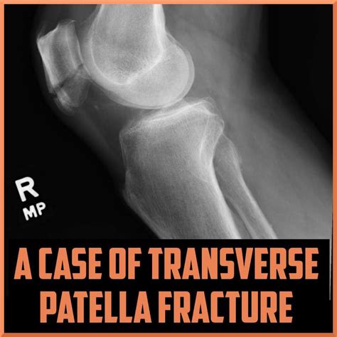 Patella Fracture Classification
