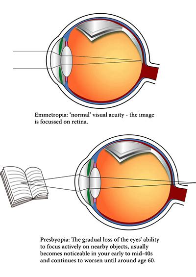 Common Vision Disorders Dr Faramarz Davidi