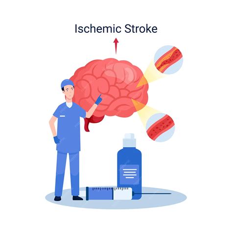 Ischemic Stroke Animation