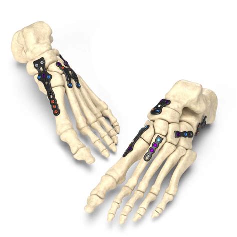 Zimmer Biomet Is Proud To Announce The Launch Of The Stratum™ Foot