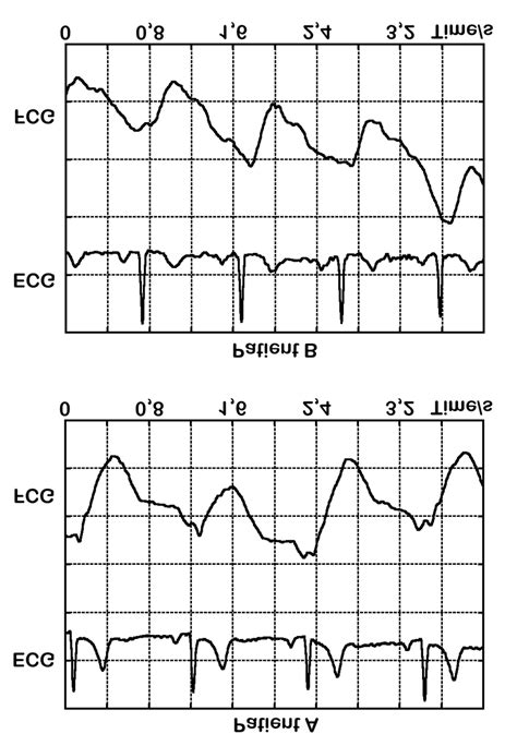 examples of simultaneously recorded ecg and fcg signals for two
