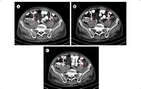 Contrast Axial Ct Images Focused On The Lesions At Psoas Muscles In