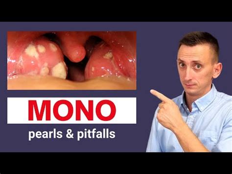 Can Infectious Mononucleosis Be Cured