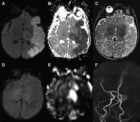 Diffusion Weighted Imaging In Neonates Radiology Key