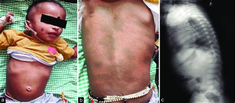 A Coarse Facies B Mongoloid Macules In The Lumbosacral Region And