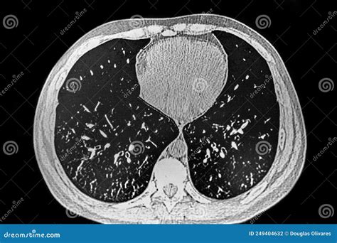 Chest Ct Scan Showing Multiple Small Lesions Compatible With Pulmonary Histoplasmosis Stock