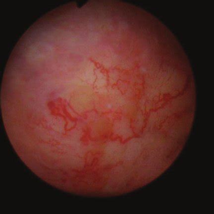 Papillary Bladder Tumor Download Scientific Diagram