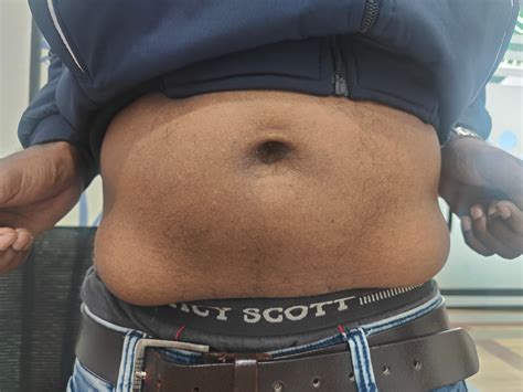 Lipohypertrophy A Common Yet Preventable Complication Of Insulin Therapy