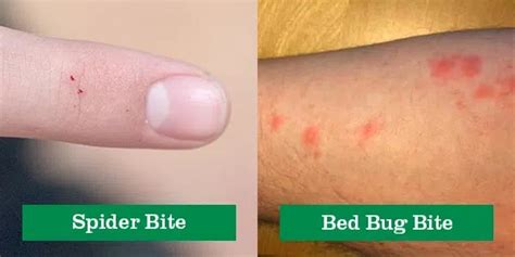 Spider Bite Vs Bed Bug Bite Green Pest Solutions