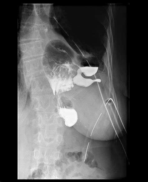 Radiopaedia Case Esophageal Pleural Fistula Spontaneous Id 52346