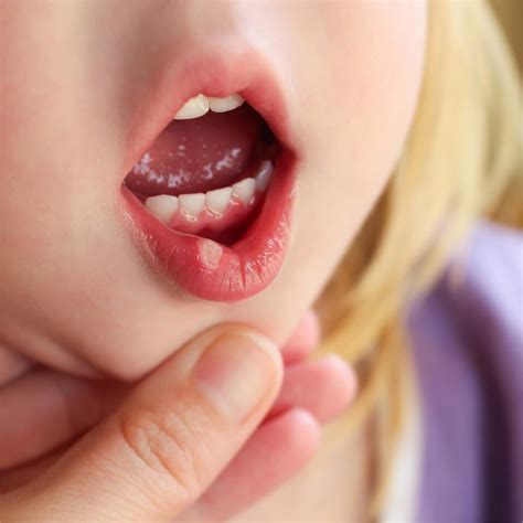 Herpes En Niños ¿cómo Tratarlo Mejor Con Salud