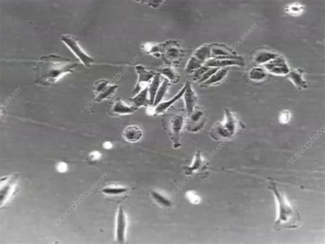 Cancer Cell Vs Normal Cell Microscope