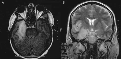 Brainstem Encephalitis