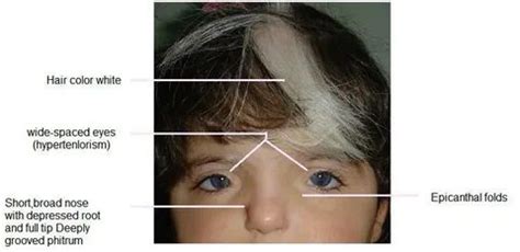 Waardenburg Syndrome смотрите и скачивайте изображения — Яндекс Картинки