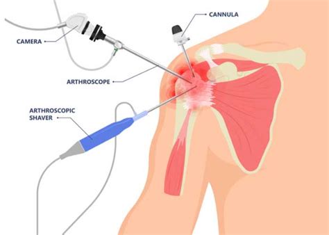 Arthroscopic Shoulder Surgery Colorado Shoulder Specialist