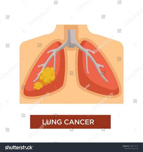 Benign Lung Tumor