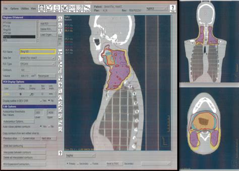 8 The First Head And Neck Plan Under Test Using Vmat Treatment