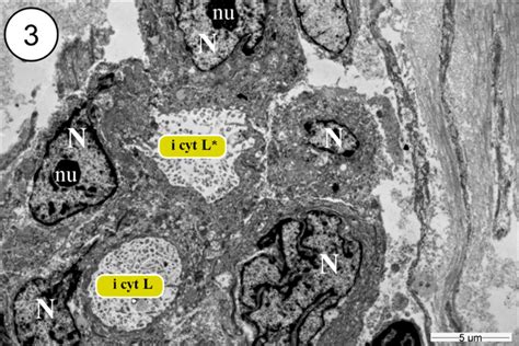 Hyperplastic Mammary Tissue Represented By Neoplasic Cells Exhibits A