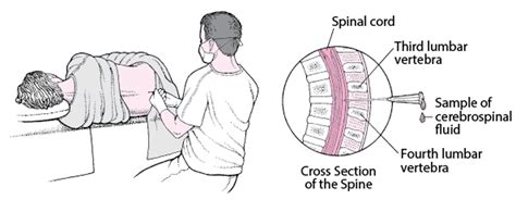 Lumbar Puncture Spinal Tap Lumbar Puncture Spinal Tap Msd