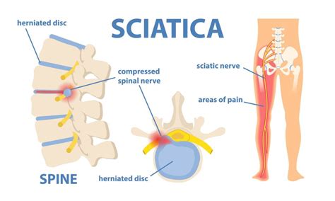 Disc Bulge And Sciatica Relief Groton Ct Non‑surgical Care