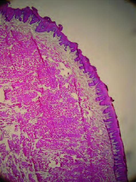 Scalpel And Scissors Sharp Dissection Margin The Epithelium Is