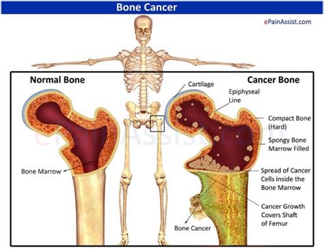 Schematic Diagram Of Normal Bone With Cancerous Bone Reproduced With Download Scientific