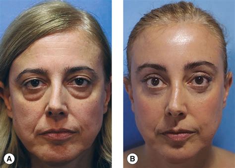 Aesthetic Surgery Of The Periocular Region And Face Clinical Tree