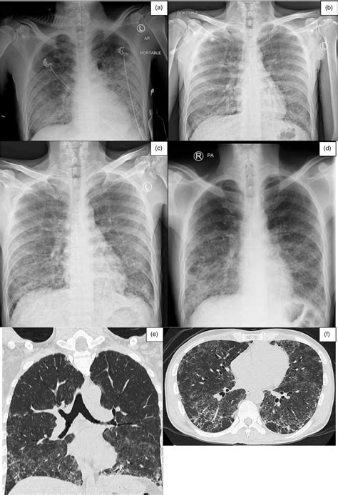 Figure 1 From Pneumocystis Jirovecii Pneumonia Co Infection With