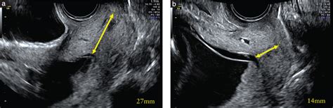 How To Measure Cervical Length Kagan 2015 Ultrasound In