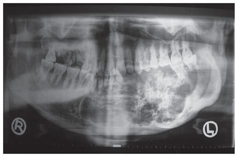 Ameloblastoma X Ray