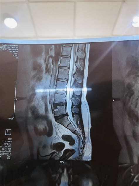 Sharing A Sagittal T2 Weighted Mri Of The Lumbar Spine Highlighting