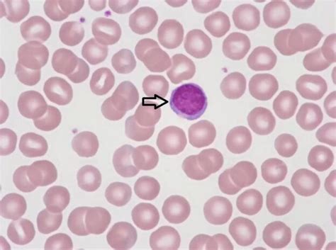 Fun Quiz Hematology Cell Identification The Mislabeled Specimen Fun