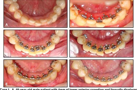Figure 1 From The Bi Helix Opening Spring For Lingual Orthodontics