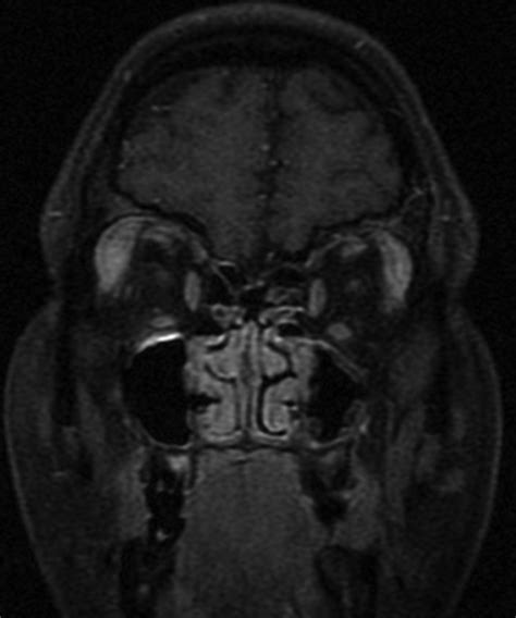 Bilateral Dacryoadenitis As Initial Presentation Of A Locally