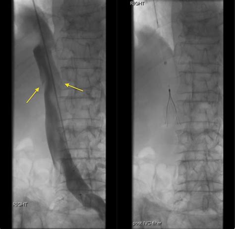 Ivc Filter Insertion Radiology At St Vincents University Hospital