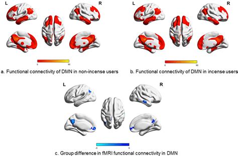 Results Of Fmri Seed Based Functional Connectivity In The Dmn Download Scientific Diagram