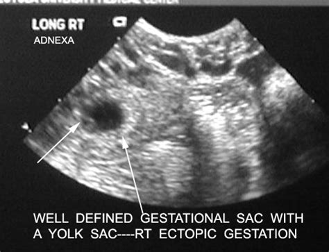 Short Arrow Points To Amorphous Material Within The Yolk Sac In The