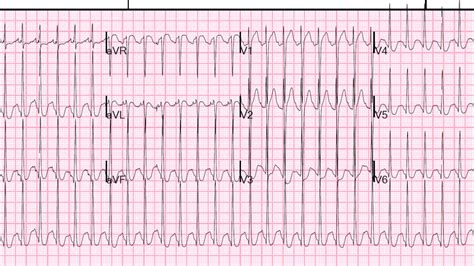 Chest Pain With Acute Rbbb Just Another Nstemi Dr Smiths Ecg Blog