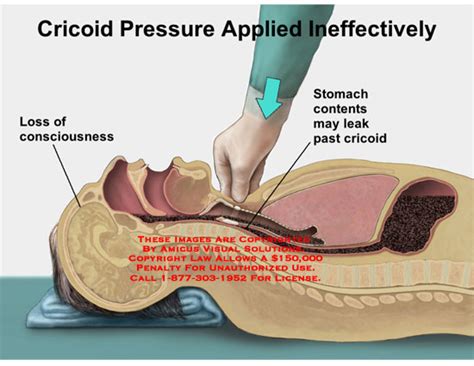Amicus Illustration Of Amicus Animation 2d Medical Cricoid Pressure