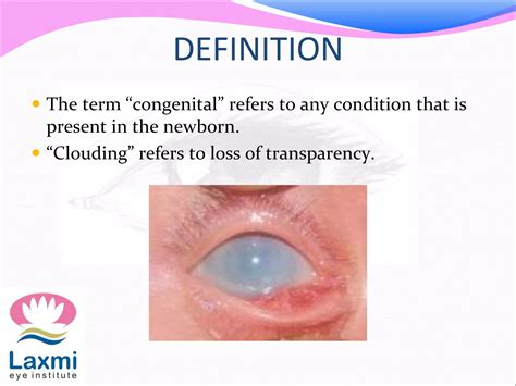 My Clouding Cornea Pptx