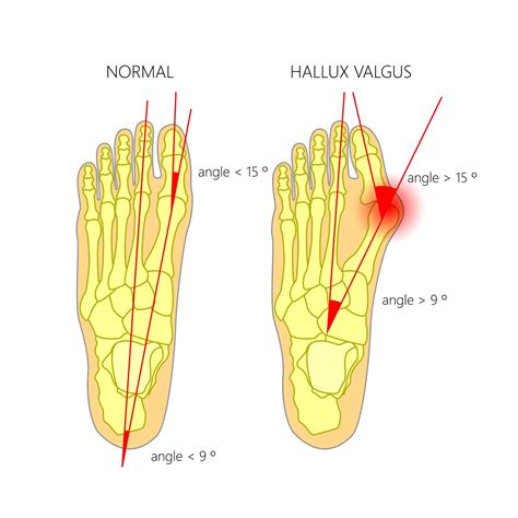 Dislocated Big Toe 5 Causes Symptoms And Best Treatment