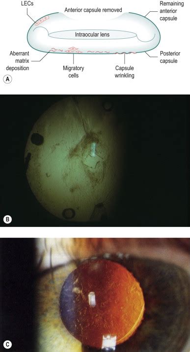 Posterior Capsule Opacification Ento Key