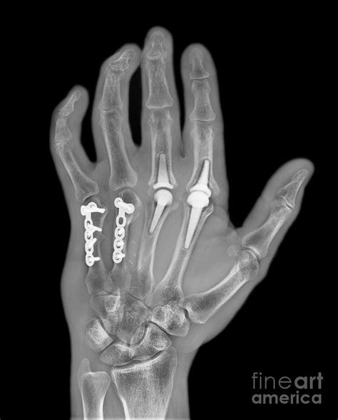 Knuckle Replacement X Ray Photograph By Science Photo Library Fine