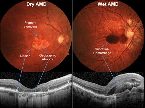 Macular Degeneration Prompt Treatment Myeyespecialist