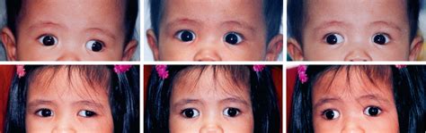 Intermittent Exotropia Clinical Tree