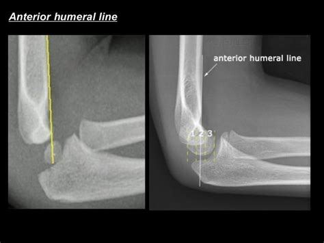 Anterior Humeral Line Supracondylar Fracture Lugbj